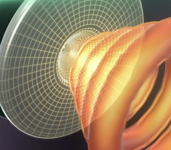 UltraWave Technology | Technologies | Alma