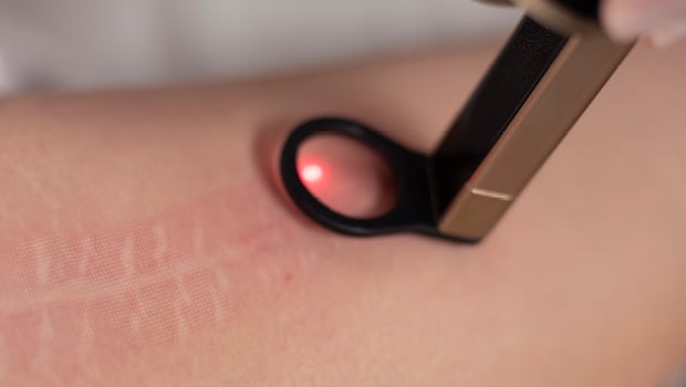 Alma Lasers' Expertise in Scar Removal Machines | Alma Blog